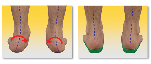 ICB heat mouldable orthotics and custom Insoles | DLT Podiatry