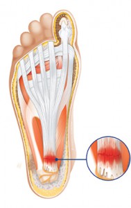 Treating Plantar Fasciitis | DLT Podiatry