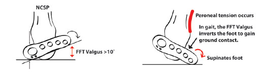 Inversion Sprain & the Effects of Forefoot Valgus | DLT Podiatry