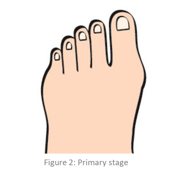 Bunion Causes & Treatment | DLT Podiatry