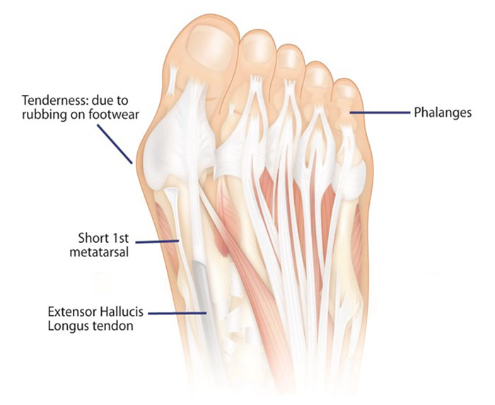 Bunion Causes & Treatment | DLT Podiatry