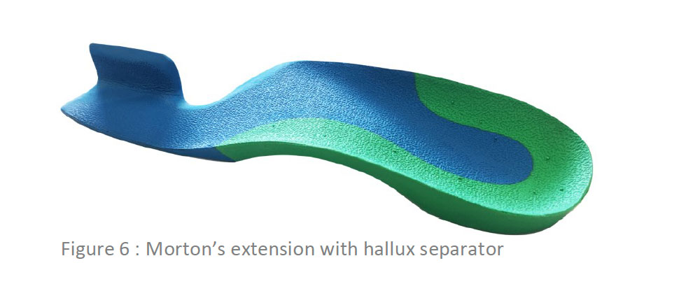 Bunion Causes & Treatment | DLT Podiatry