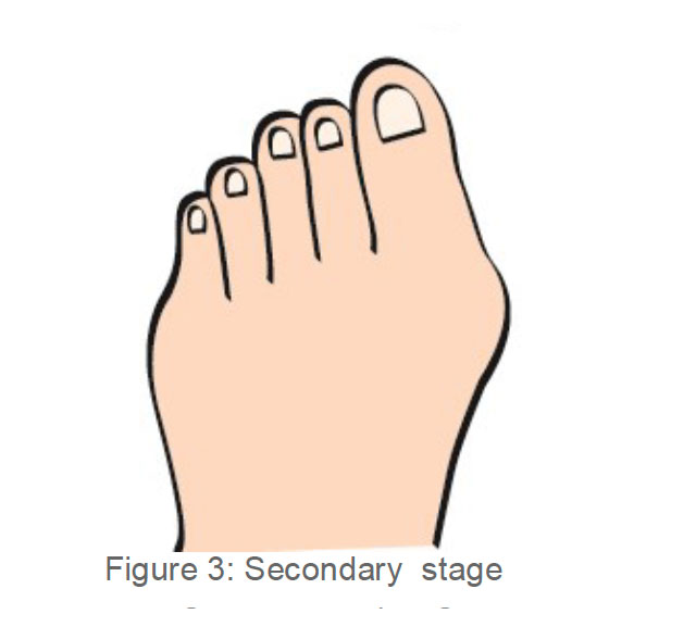 Bunion Causes & Treatment | DLT Podiatry