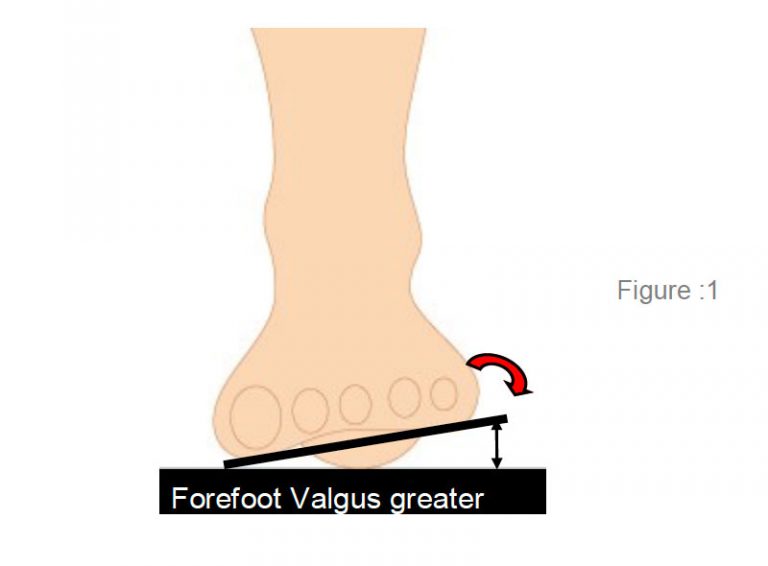 Shin Splints | DLT Podiatry