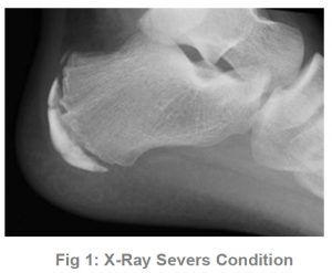 Severs Condition | DLT Podiatry
