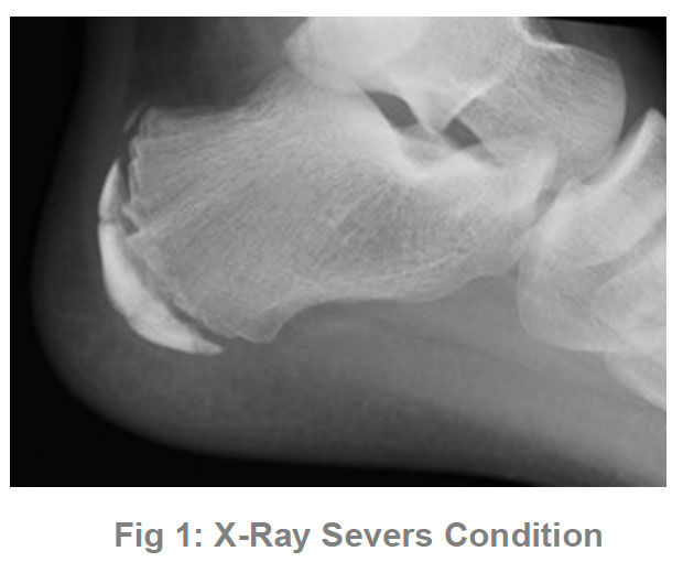 Severs Condition | DLT Podiatry