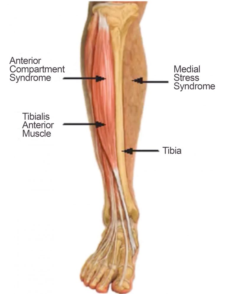 Shin Splints | DLT Podiatry