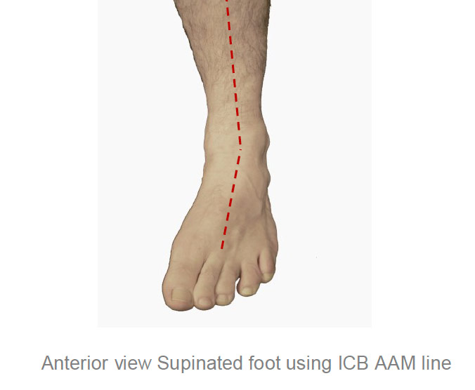 Inversion Sprain and the effects of Forefoot Valgus | DLT Podiatry