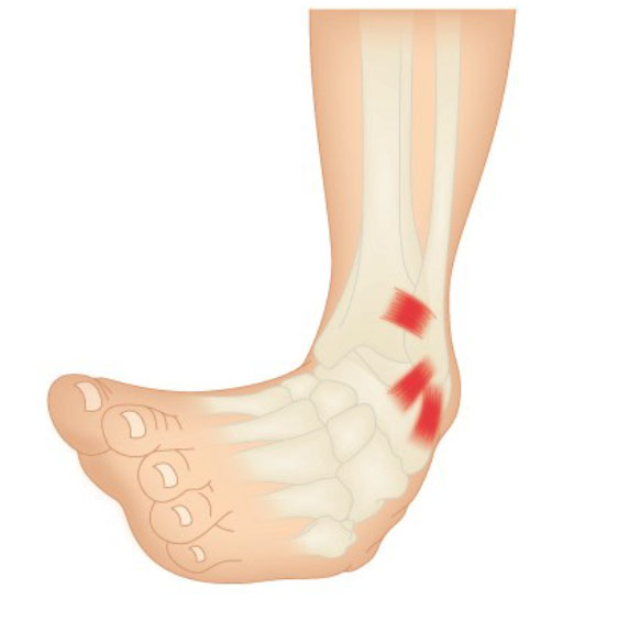 Inversion Sprain | DLT Podiatry