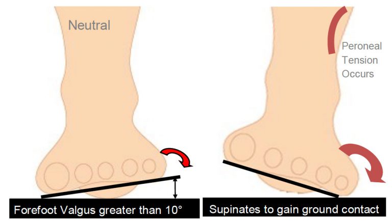 Inversion Sprain and the effects of Forefoot Valgus | DLT Podiatry