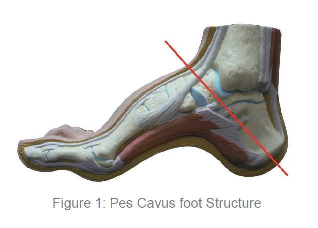 Inversion Sprain and the effects of Forefoot Valgus | DLT Podiatry