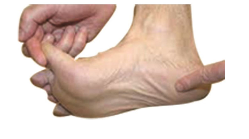Hallux Limitus | DLT Podiatry
