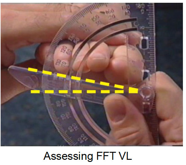 Treating Supinated Feet with Orthotics | DLT Podiatry