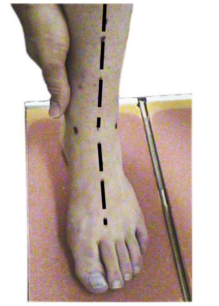 Orthotics The ICB Anterior Alignment Method | DLT Podiatry