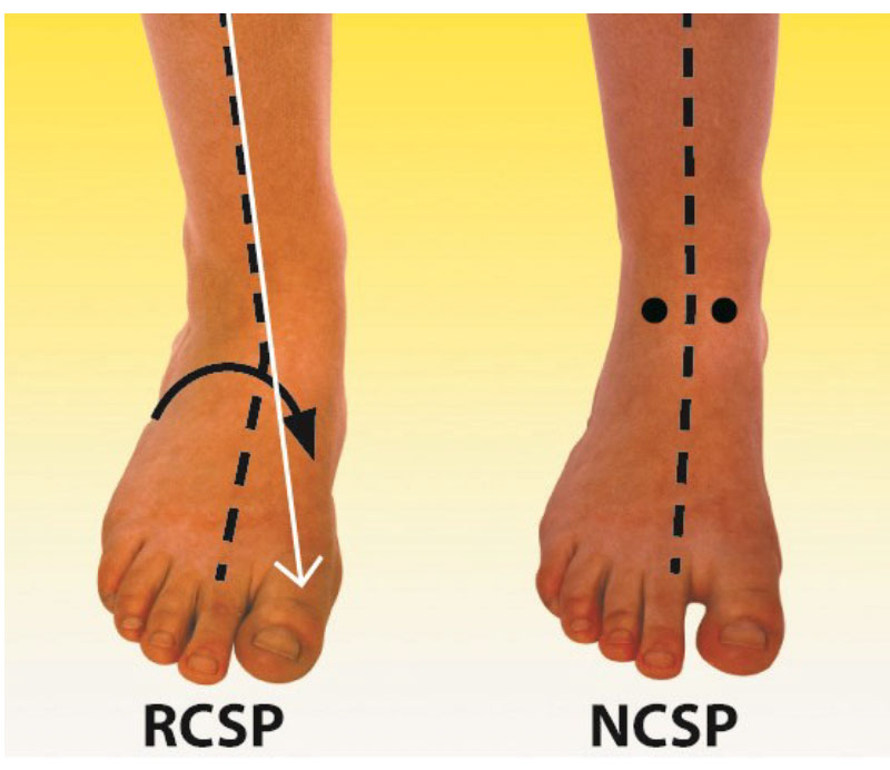 Orthotics The ICB Anterior Alignment Method | DLT Podiatry