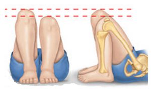 Leg Length Discrepancy | DLT Podiatry