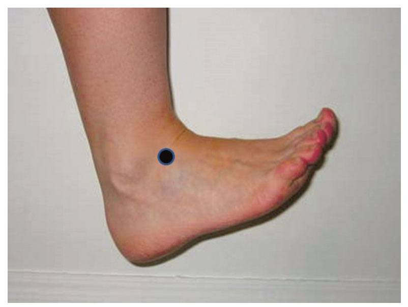 Orthotics The ICB Anterior Alignment Method | DLT Podiatry