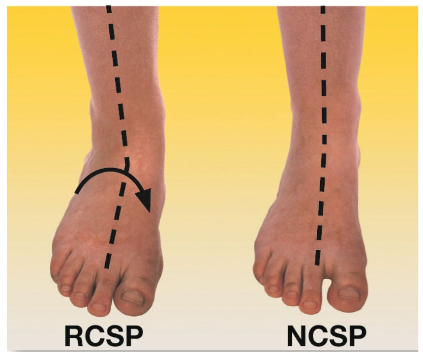 Orthotics The ICB Anterior Alignment Method | DLT Podiatry