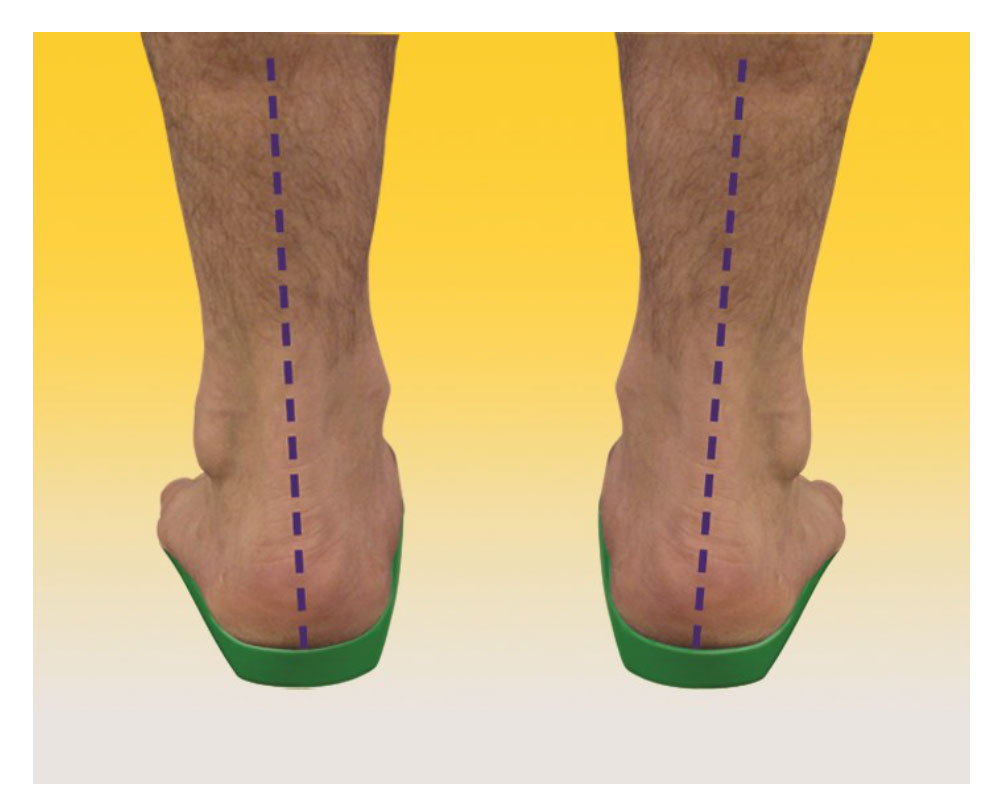 Medial Knee Pain Causes and Treatments | DLT Podiatry