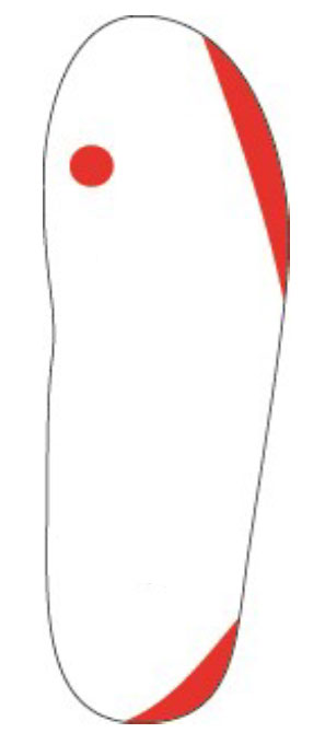 Treating Supinated Feet with Orthotics | DLT Podiatry