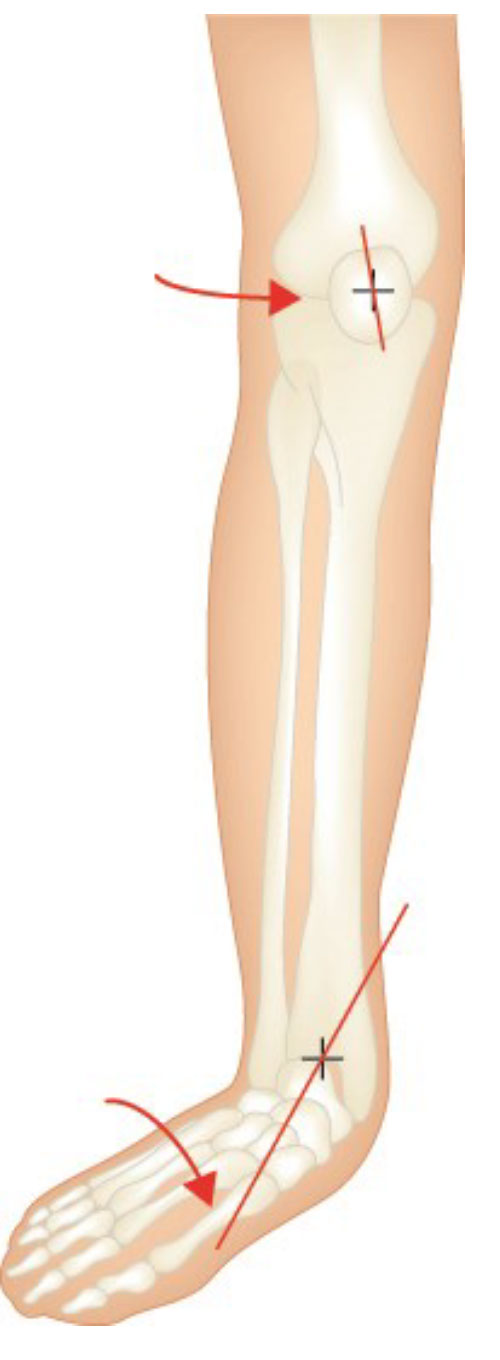 Using Sports Tape & Orthotics | DLT Podiatry