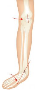 Medial Knee Pain Causes and Treatments | DLT Podiatry