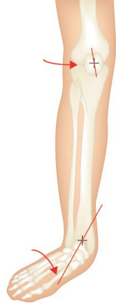 Medial Knee Pain Causes and Treatments | DLT Podiatry