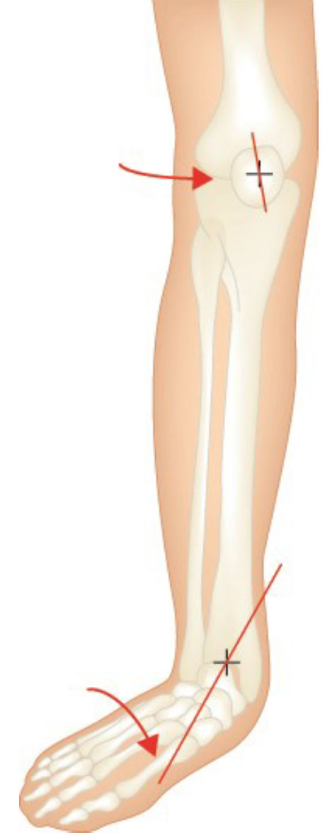 Medial Knee Pain Causes and Treatments | DLT Podiatry