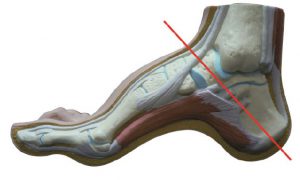 Treating Supinated Feet with Orthotics | DLT Podiatry