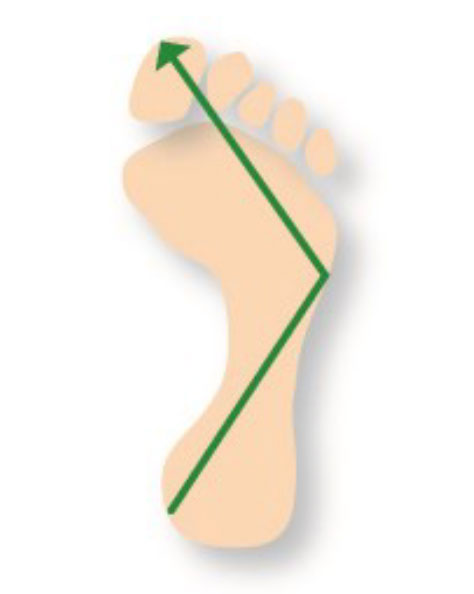 Treating Supinated Feet with Orthotics | DLT Podiatry