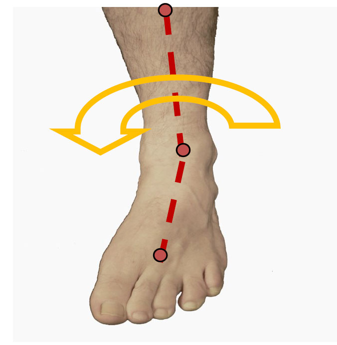 Treating Supinated Feet with Orthotics | DLT Podiatry