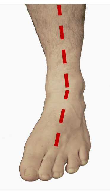 Treating Supinated Feet with Orthotics | DLT Podiatry