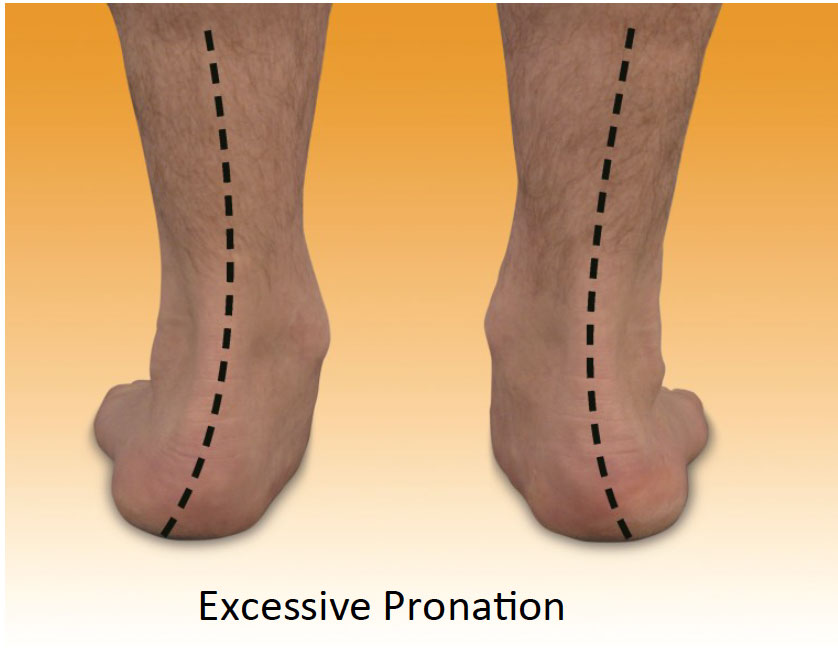 Anterior Knee Pain | DLT Podiatry