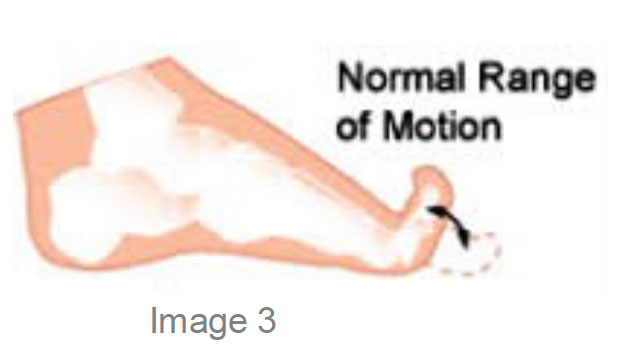 Dorsiflexed 1st Metatarsal | DLT Podiatry