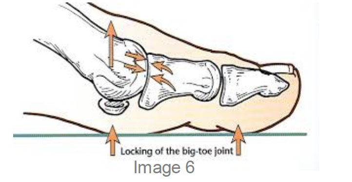 Dorsiflexed 1st Metatarsal | DLT Podiatry