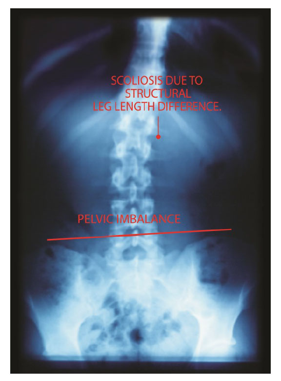 Treating Large leg length differences with orthotics | DLT Podiatry