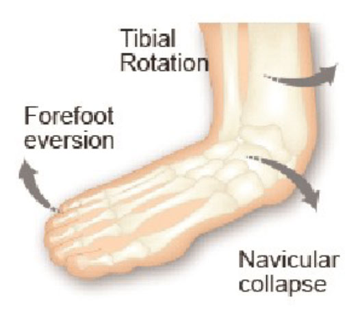 Forefoot Varus or Forefoot Supinatus? | DLT Podiatry