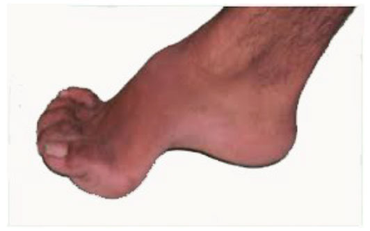 Pes Cavus Feet and Orthotics | DLT Podiatry
