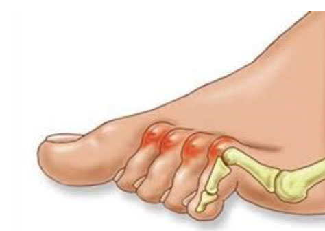 Pes Cavus Feet and Orthotics | DLT Podiatry