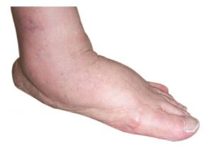 Forefoot Varus or Forefoot Supinatus? | DLT Podiatry