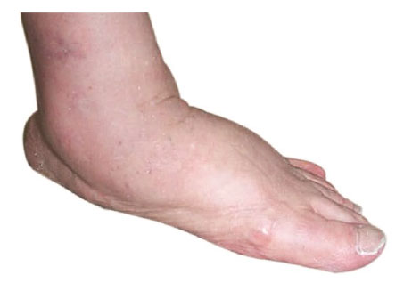 Forefoot Varus or Forefoot Supinatus? | DLT Podiatry