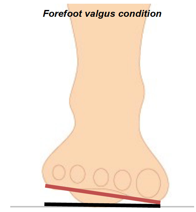 Assessing Forefoot Valgus | DLT Podiatry