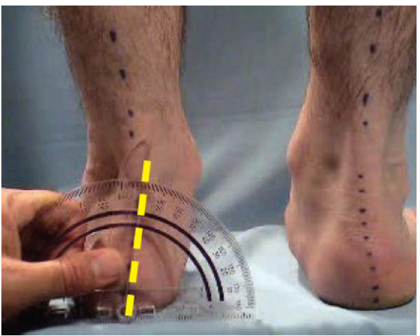 Modifying Orthotics | DLT Podiatry