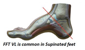 Assessing Forefoot Valgus | DLT Podiatry