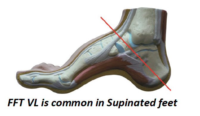 Assessing Forefoot Valgus | DLT Podiatry