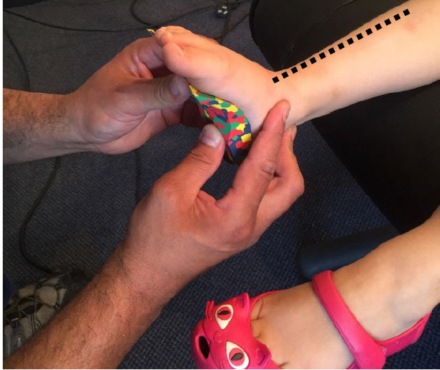 Heating and moulding Orthotics | DLT Podiatry