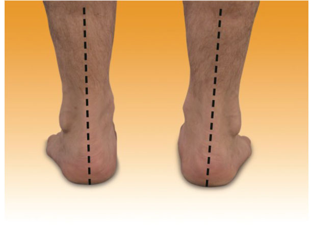 Orthotics | DLT Podiatry