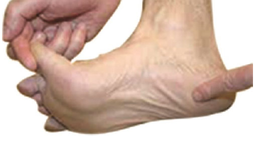 Plantar Fascial Groove | DLT Podiatry